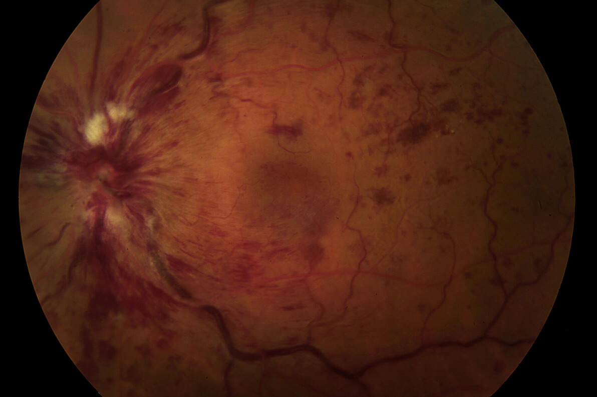 Retinal Vascular Occlusion Livingston | Retina Morristown | Glaucoma