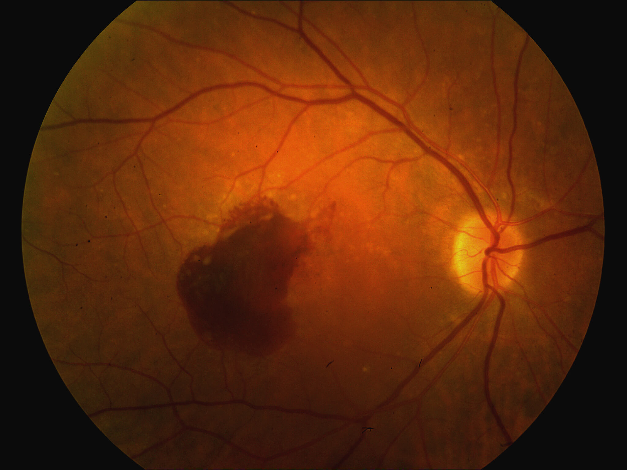 Macular Degeneration Livingston | AMD Morristown | RVC-NJ